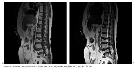 Mri Sequences Fast Spin Echo E Mri