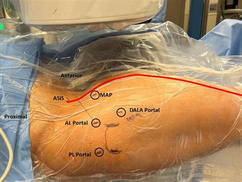 Posterolateral Acetabular Labral Repair Drilling Using A Percutaneous