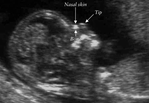 Learning Curve For Sonographic Examination Of The Fetal Nasal Bone At