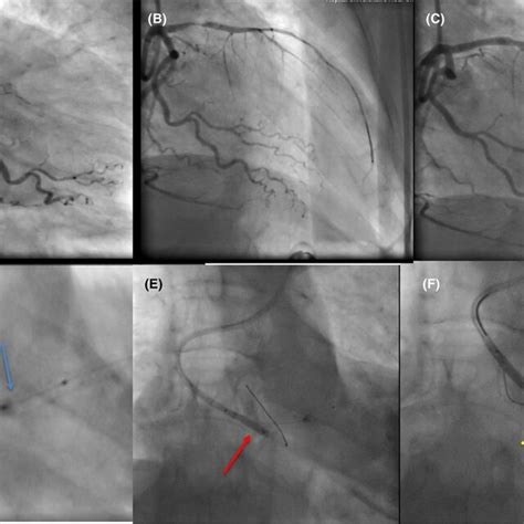 Procedure Steps A Acute Total Occlusion Of The Proximal Lad B Download Scientific Diagram