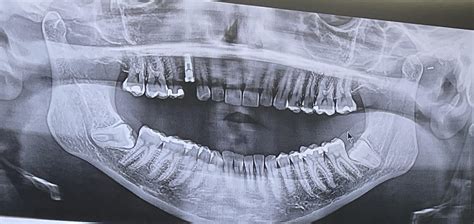 Todays Jaw Dislocation R Tmj