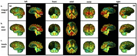 Rs Functional Connectivity Results Unthresholded Images Showing