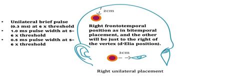 Shows The Positioning Of A Right Unilateral Rul Electrode Placement [36] Download