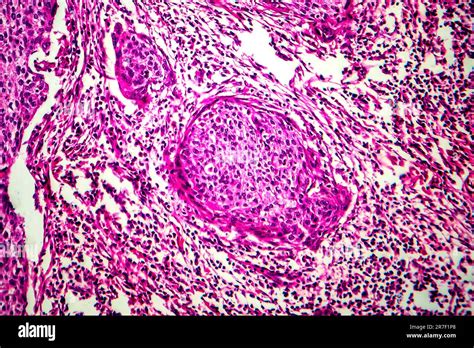 Cervical Cancer Light Micrograph Lm Of A Section Through A Squamous