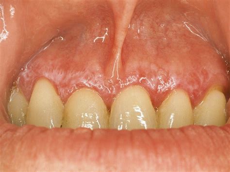 Oral Lichen Planus Gums