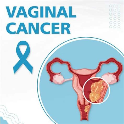Vaginal Cancer Signs And Symptoms Uhapo