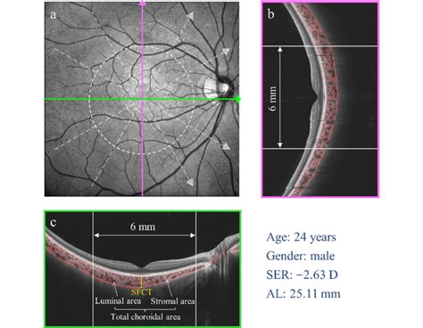 Illustration Of Choroidal Vasculature Analysis A Schematic Diagram Of