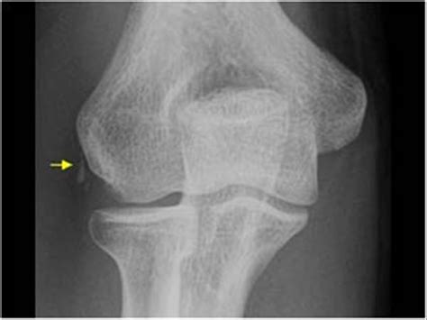 Lateral And Medial Epicondyle Musculoskeletal Joints And Tendons 62