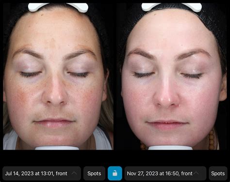 Skincare Before And After Photos Face Forward Medical Aesthetics