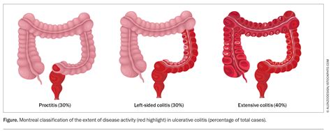 Ulcerative Colitis An Update On Management Medicine Today