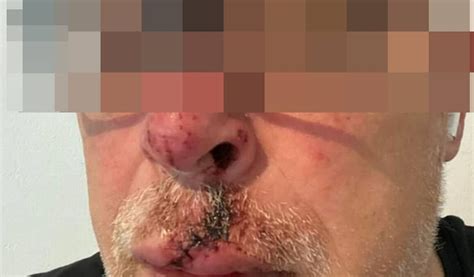 Blut Riss In Der Lippe Zahn Verloren Hamburger Von Radfahrer Umgestürzt Mopo