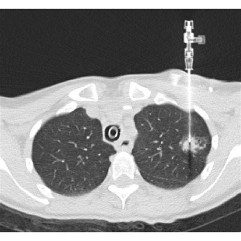 Ct Image During Lung Biopsy With Guiding Needle Combined With