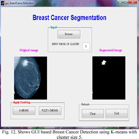 Figure 12 From Gui Based Automatic Breast Cancer Mass And Calcification Detection In Mammogram