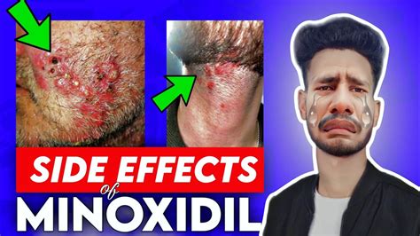 Minoxidil Beard Side Effects Side Effects Of Minoxidil Beard Minoxidil Se Konse Side