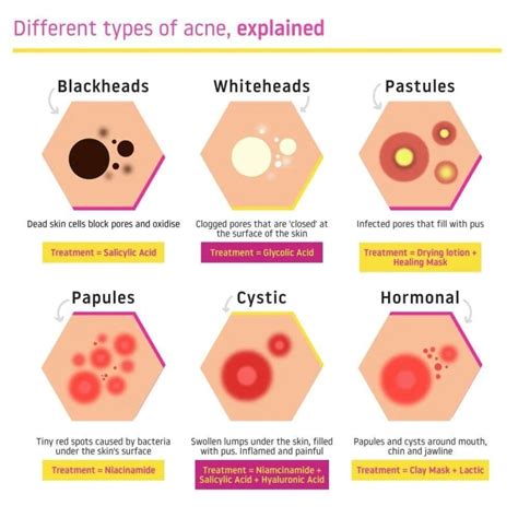 What Are The Different Types Of Acne Infographic