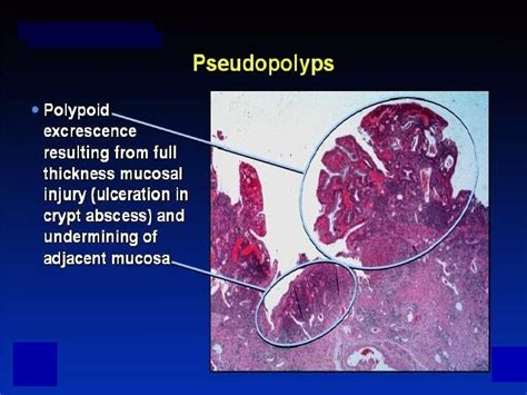 21 Ulcerative Colitis