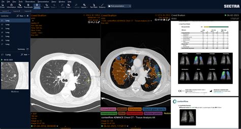 Contextflow Advance Chest Ct Sectra Amplifier Marketplace