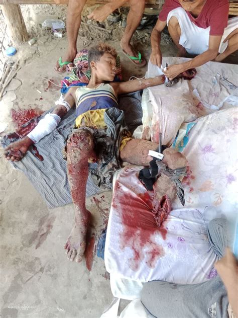 အကြမ်းဖက်စစ်ကောင်စီတပ်ထောင်ထားခရေ လက်ကျန်မိုင်းနင်းမိရာမှပေါက်ကွဲမှုဖြစ်လို့ ရသေ့တောင်ဒေသခံ