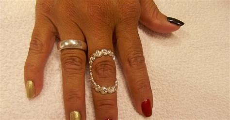 Rheumatologe Correcting Swan Neck Deformity In An Elegant Way