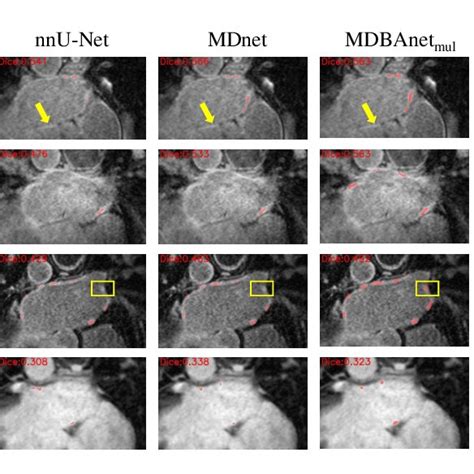 Visualization Of Different Scar Segmentation Methods Yellow Arrows