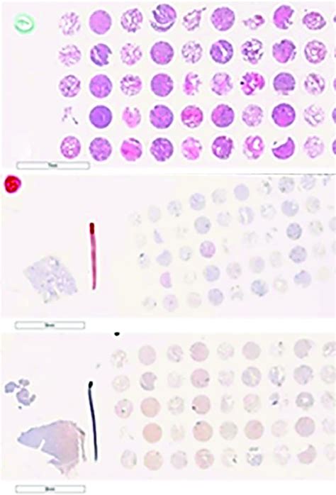 tissue microarray slides stained for hande her2 cep17 dish and c myc