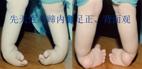 马蹄内翻足的康复治疗 知乎