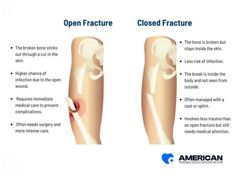 How To Immobilize A Fracture First Aid Guide