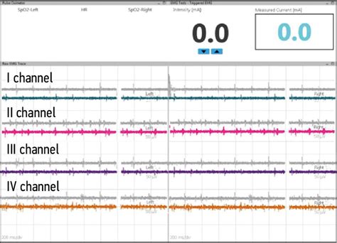 Data Of Intraoperative Neurophysiological Monitoring Using An Epidural Download Scientific