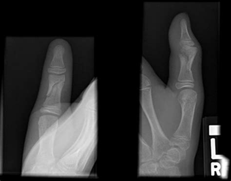 Initial Radiologic Appearance Showing Fractured Proximal Phalanx Of Download Scientific Diagram