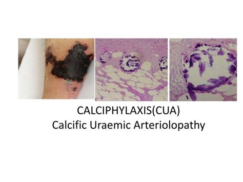 Calciphylaxis Pptx