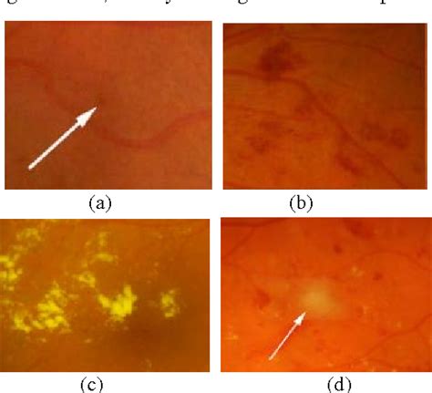 Figure 1 From Automatic Detection Of Hard Exudates In Diabetic Retinopathy Using Morphological