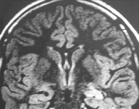Cranial Mri Showing Left Mesial Temporal Sclerosis Download Scientific Diagram
