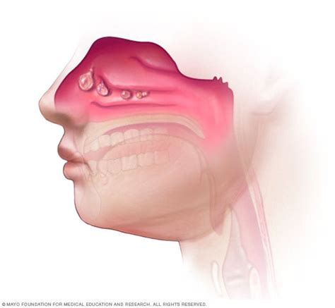 Nasal Polyps Mayo Clinic