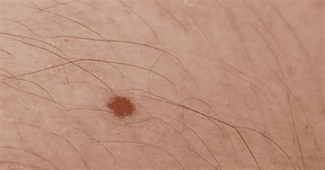 سرطان الجلد هذه العلامة دليلك للكشف المبكر سكاي نيوز عربية