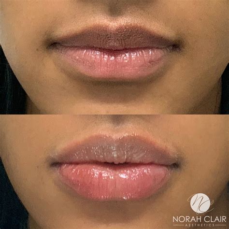 Botox Vs Fillers Dermatologists On The Difference Between The
