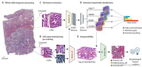 【论文笔记】通过可解释的深度学习模型从病理切片识别癌症分子亚型病理切片 深度学习 论文 Csdn博客