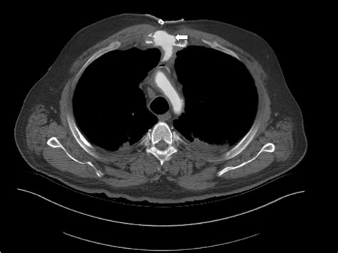 Figure 10 From The Use Of Contrast Enhanced Post Mortem Ct In The