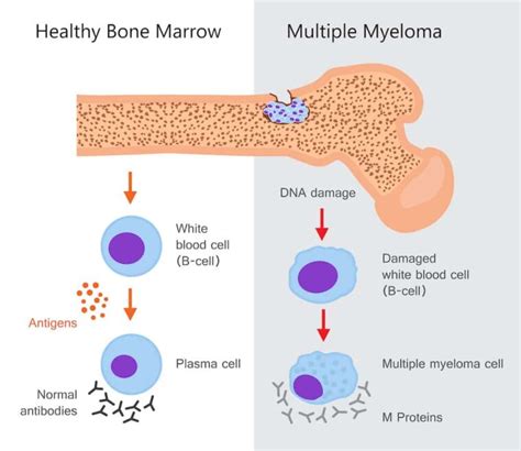 Multiple Myeloma Signs And Symptoms Causes Stages Types Diagnosis