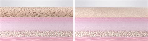 피부 건조 죽은 세포 각질 제거 과정 3d 렌더링 일러스트레이션 각질제거에 대한 스톡 사진 및 기타 이미지 각질제거 건강관리와 의술 광고 Istock