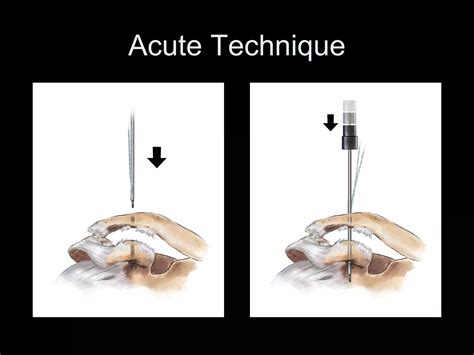 Reconstruction Of Shoulder Separation And Ac Dislocation Ppt