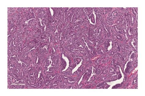 Retiform Pattern With “staghorn” Slit Like Tubules Hande At 100x