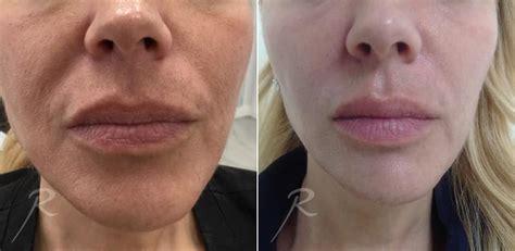 Platelet Rich Plasma Prp Treatment For Skin Rejuvenation And Hair