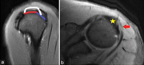 A Plane Based Approach For The Characterization Of Supraspinatus Tendon Tear At The Footprint In