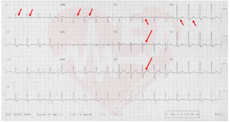 Av Nodale Re Entry Tachycardie Avnrt Ecg Academie