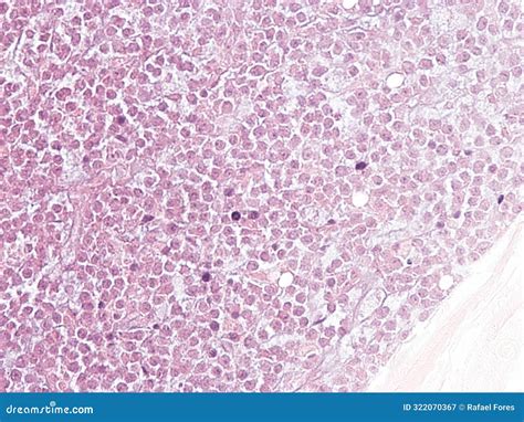 Burkitt Lymphoma Bone Marrow Stock Image 341002027