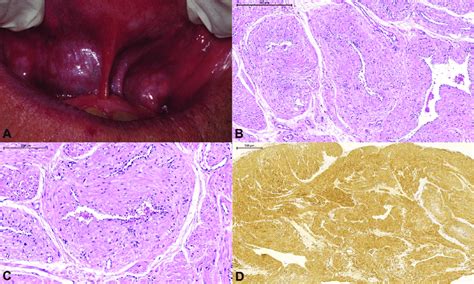 Case 1 A Submucosal Nodule Similar In Color To The Adjacent Mucosa Download Scientific