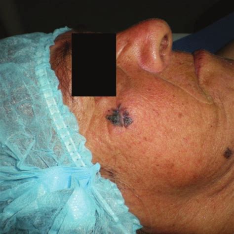 Biopsia Preoperatoria Del Melanoma De La Región Malar Se Observa Un Download Scientific