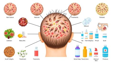 8 Types Of Scalp Folliculitis And How To Effectively Treat Them