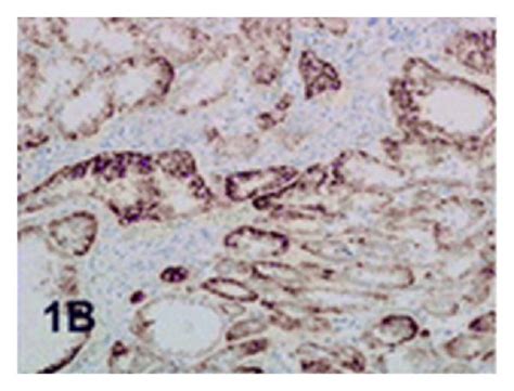 This Figure Shows Architectural Patterns Of Clear Cell Adenocarcinomas