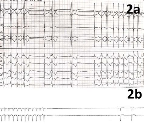 2a Ecg Day 7 Intermittent Conversion To Sr With A Slow Hr 40 50 Download Scientific Diagram